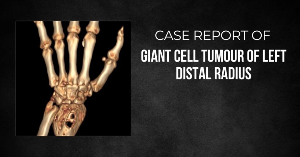 Case Report of Giant cell tumour of Left distal Radius - Vasudhev ...